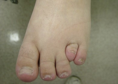 Brachymetatarsalgia or short toe | Arch City Foot & Ankle