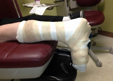 Healing a diabetic ulcer with total contact casting | Arch City Foot ...